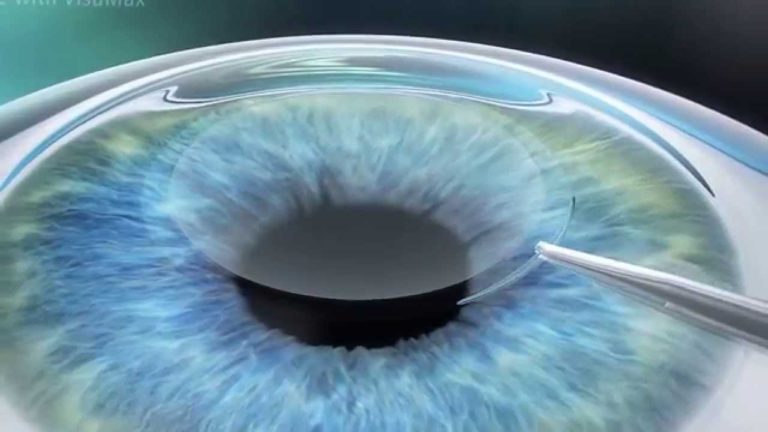 SMILE (Small Incision Lenticule Extraction) – Central Florida Eye ...